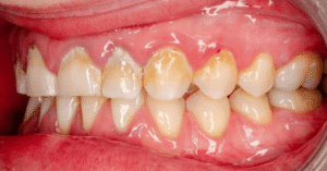 Calculus Bridge: Understanding Causes, Risks, and Complete Care ...